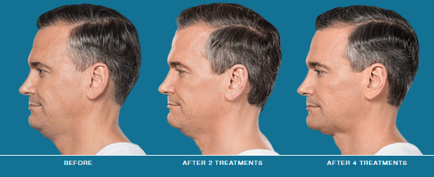 KYBELLA ® Injections for Submental Fat Reduction | SkinShine MedSpa