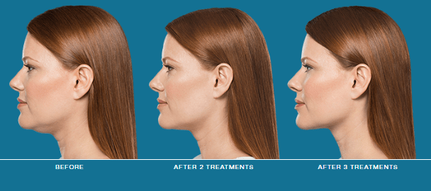 KYBELLA ® Injections for Submental Fat Reduction | SkinShine MedSpa